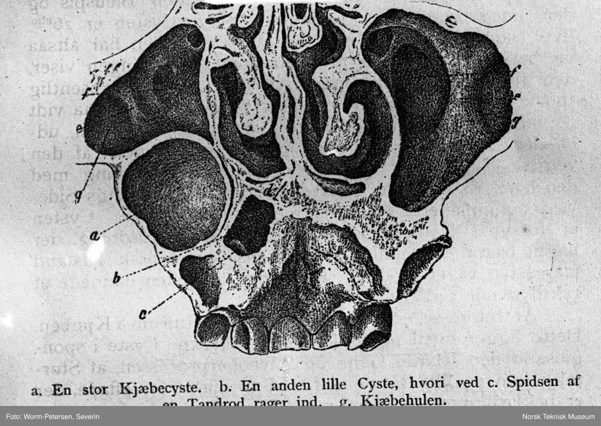 Illustrasjon; Cyste i overkjeven - Norsk Teknisk Museum / DigitaltMuseum